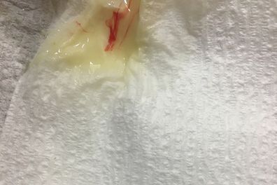 Yellow Clumpy Discharge With Blood